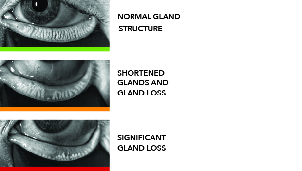 Dry Eye - Victoria Eye