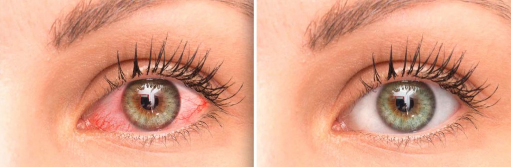 Dry Eye - Victoria Eye