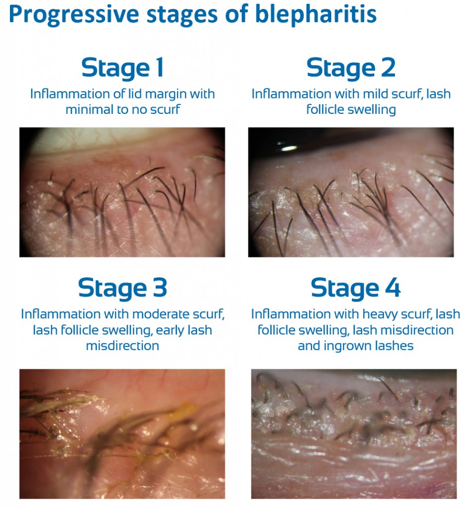 Dry Eye - Victoria Eye